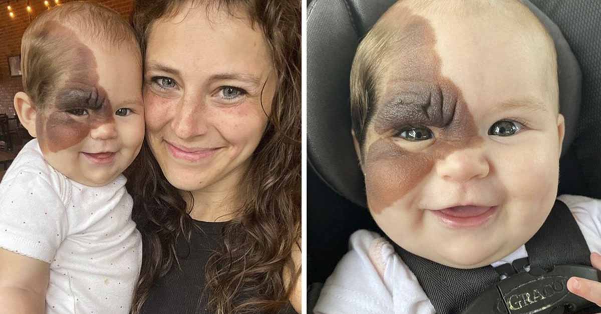 Mom wants to show daughter with extremely rare birthmark that she is ...