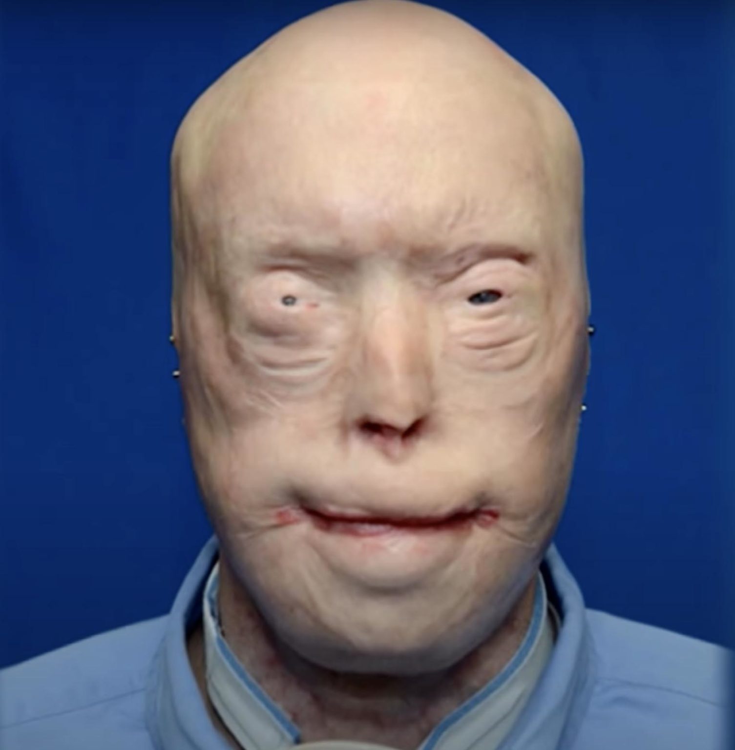Brave firefighter has face transplant after suffering third-degree ...
