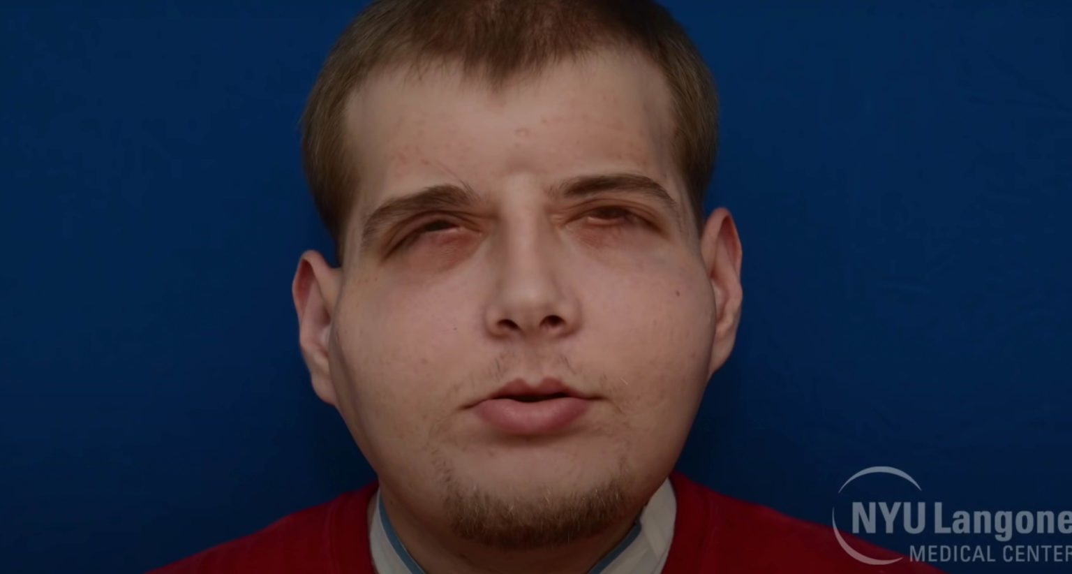 Firefighter suffers third-degree burns – this is him 7 years later