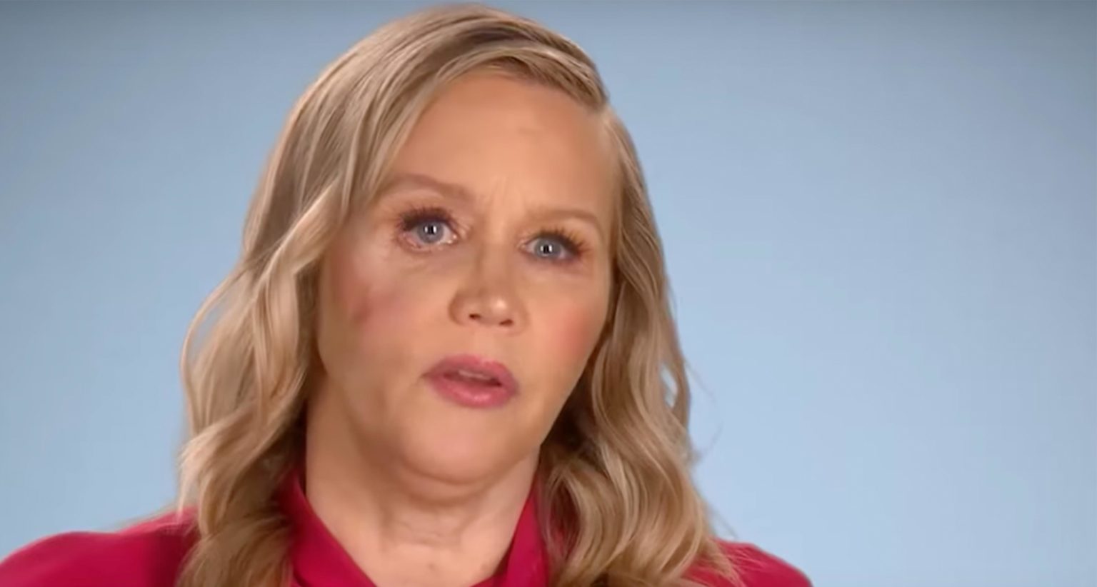 Gina Anderson, 40, was left with giant hole in her face after filler ...