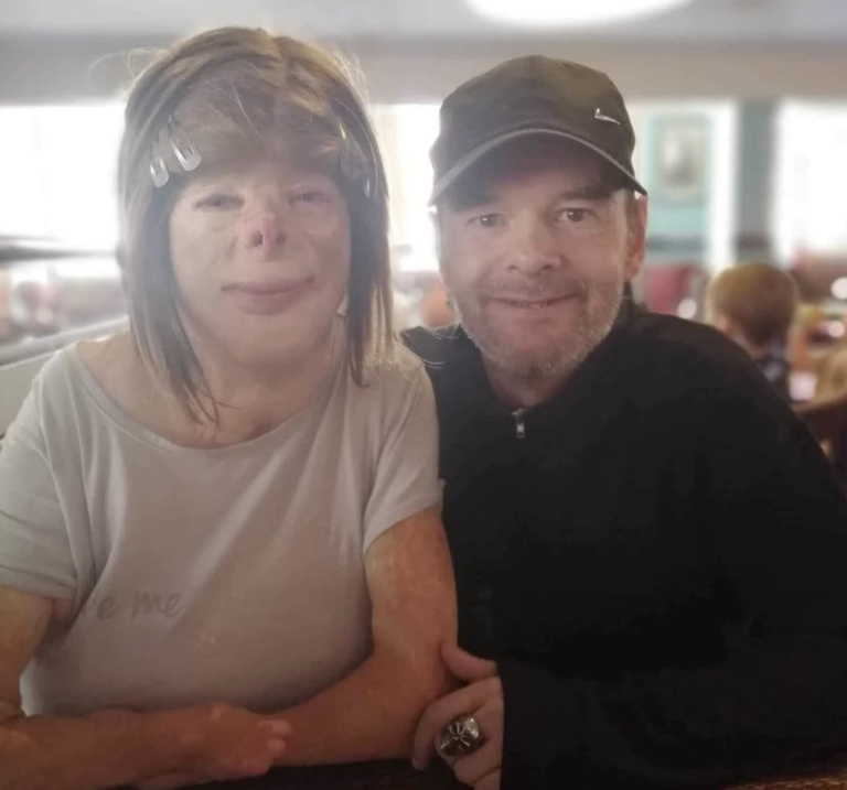 Terri Calvesbert survived fire against all odds – here's her today