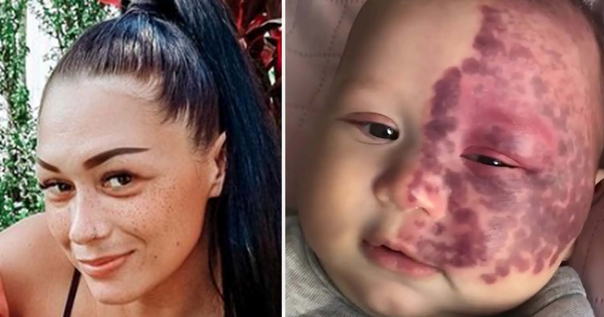 Port wine Stain Birthmark Read Up On All The Latest About Port wine Port wine Stain Birthmark Read Up On All The Latest About Port wine