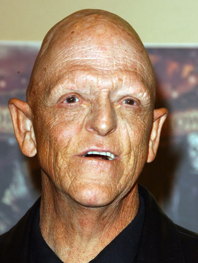 Michael Berryman became an actor despite his rare congenital disability ...