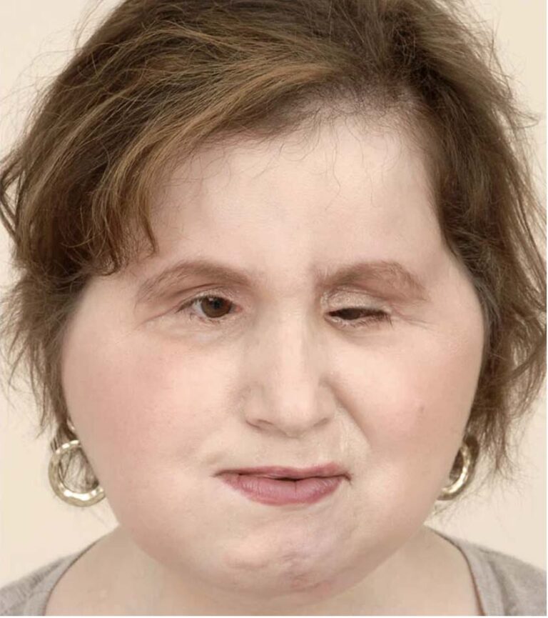 Katie Stubblefield gets new face after transplant – this is her today