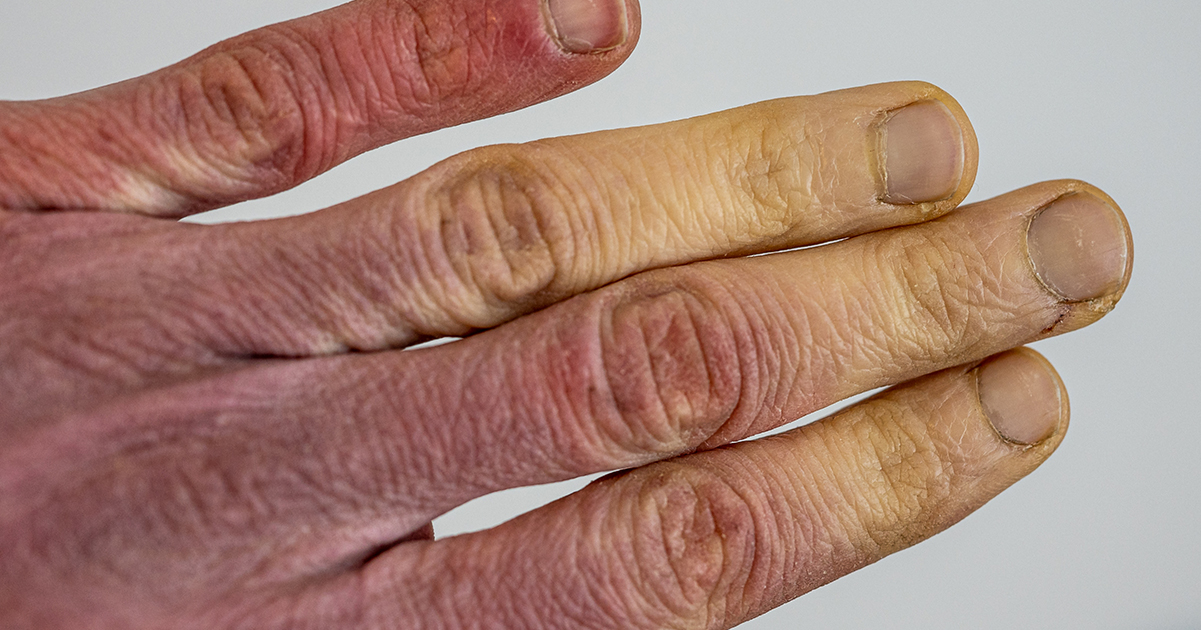 Doctors warn of disease if your fingers change color in cold