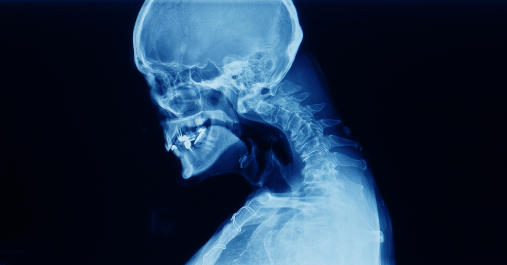 23-year-old has rare condition called 'dropped head syndrome'