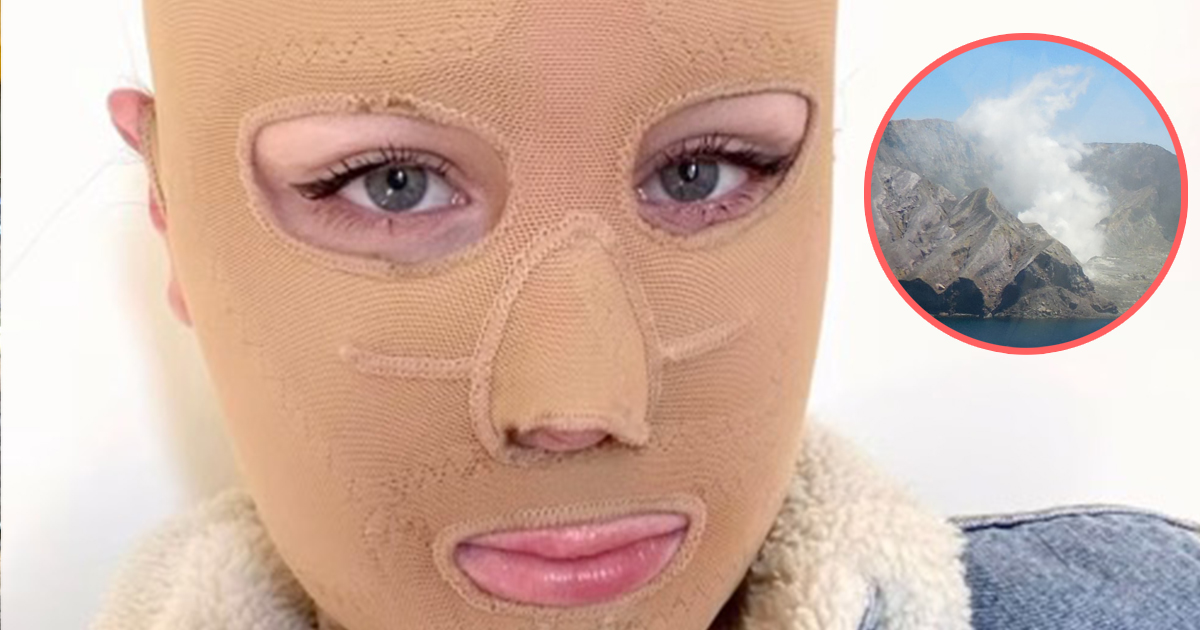 Woman burned in volcano tragedy reveals how she looks five years on