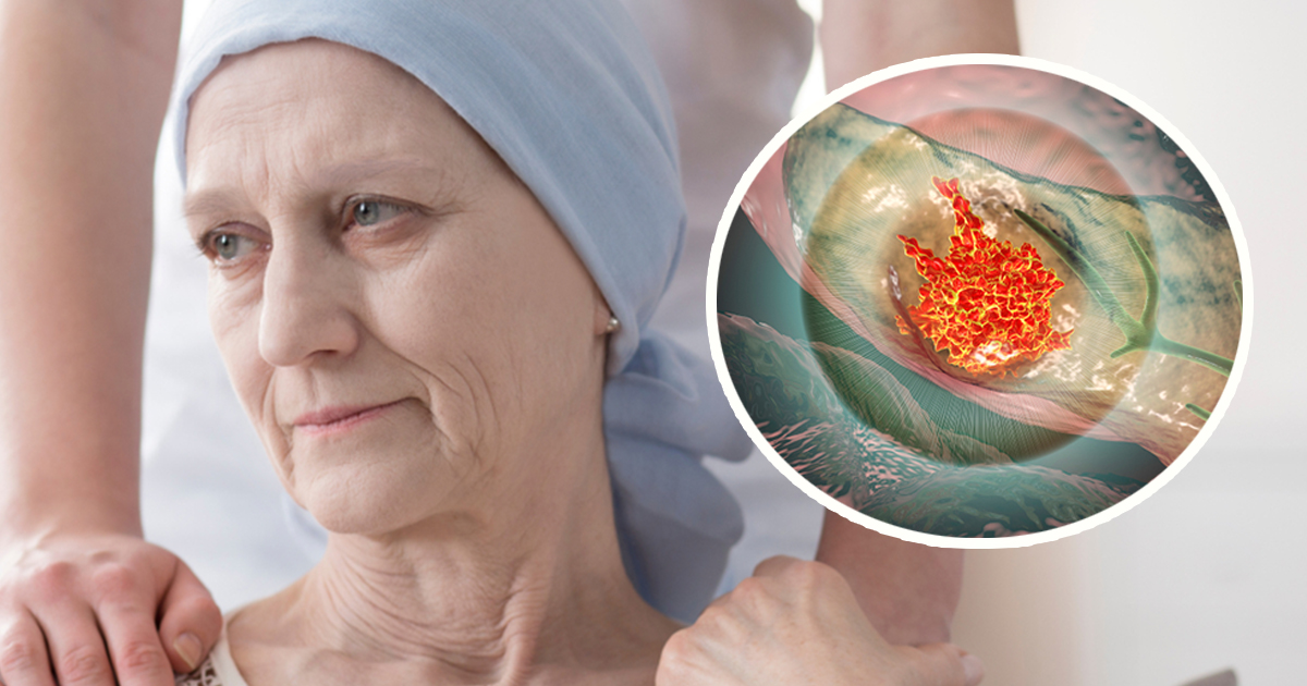Signs of pancreatic cancer you should never ignore