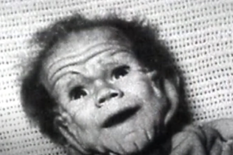 Tomm Tennent: Wyjątkowe dziecko, które urodziło się z ilością skóry ...