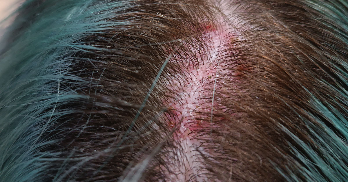 Päänahan näppylät kertovat yllättävän paljon terveydestäsi