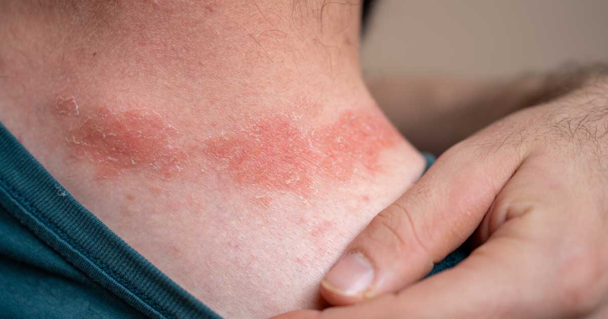 Psoriasis ja sen eri muodot – näin tunnistat oireet