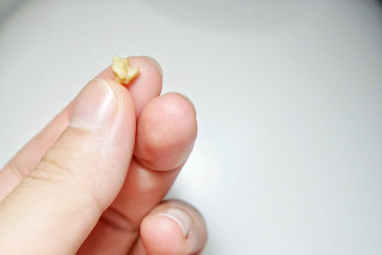 Mandelsteine: Fast jeder Fünfte leidet darunter – Das solltest du ...