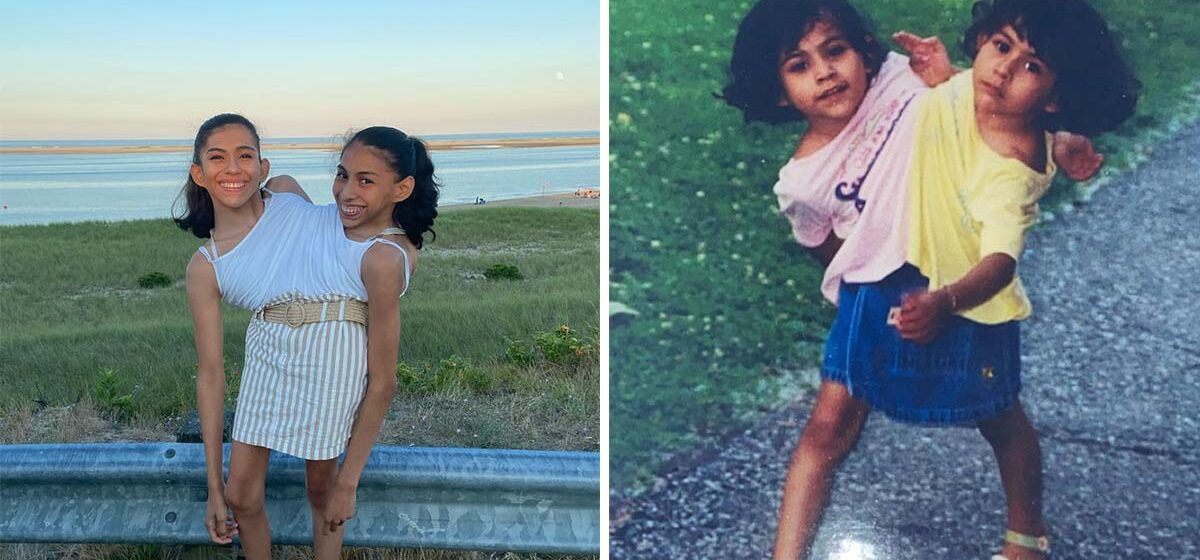 Há 22 anos, as gêmeas siamesas chegaram às manchetes em todo o mundo ...