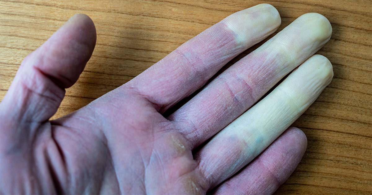 Artsen waarschuwen over van kleur veranderende vingers