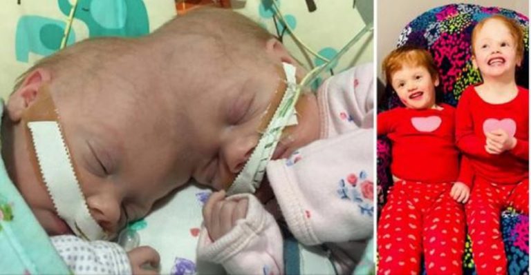 Jumelles siamoises, Abby et Erin Delaney: leur histoire remarquable