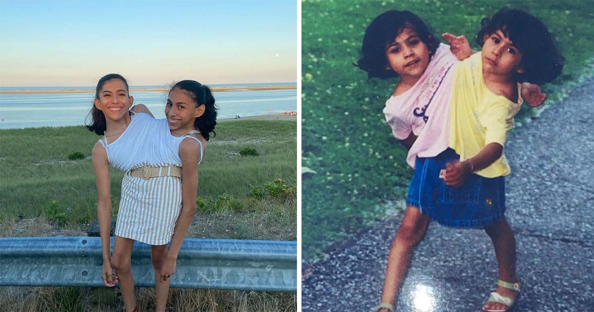 Il y a 22 ans, Ces jumelles siamoises ont fait la une des journaux du ...