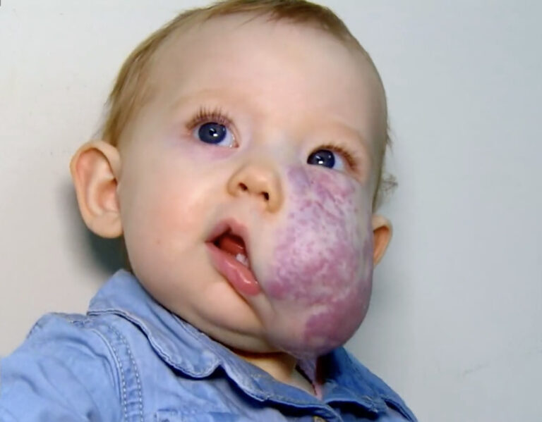 Une petite fille est née avec une tumeur géante sur le visage – de ...