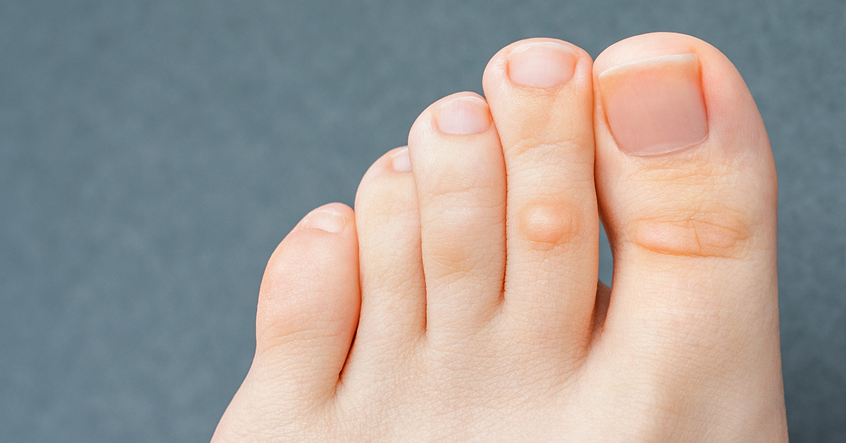 Ongles épais : symptômes, causes et solutions efficaces